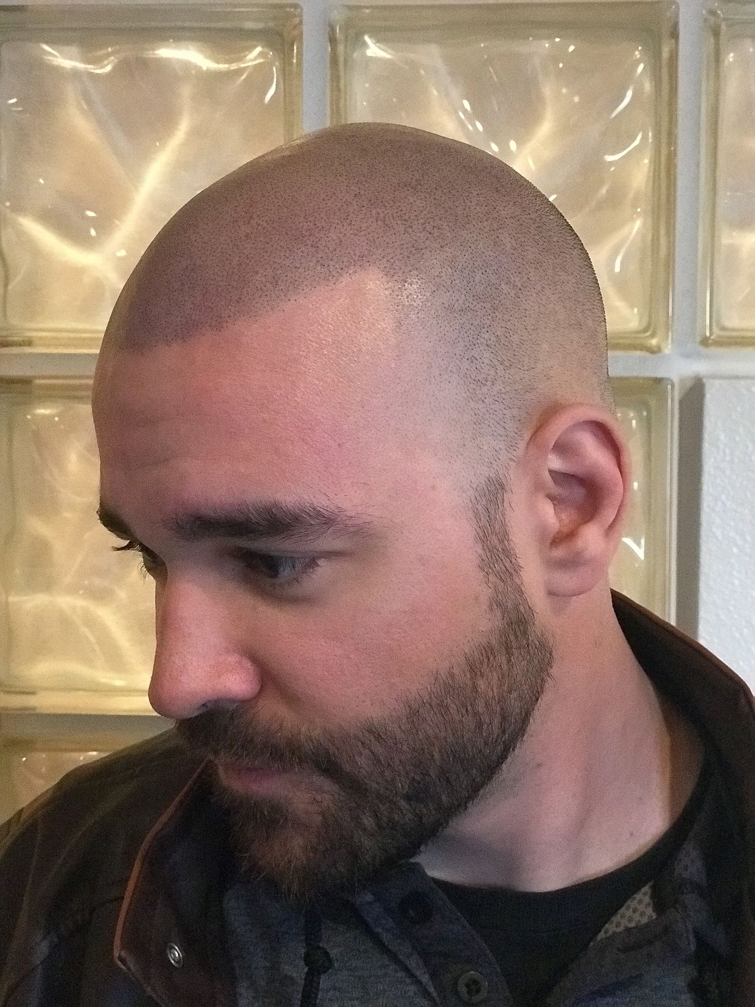 Scalp Micropigmentation Cost Information for treatments in Portland